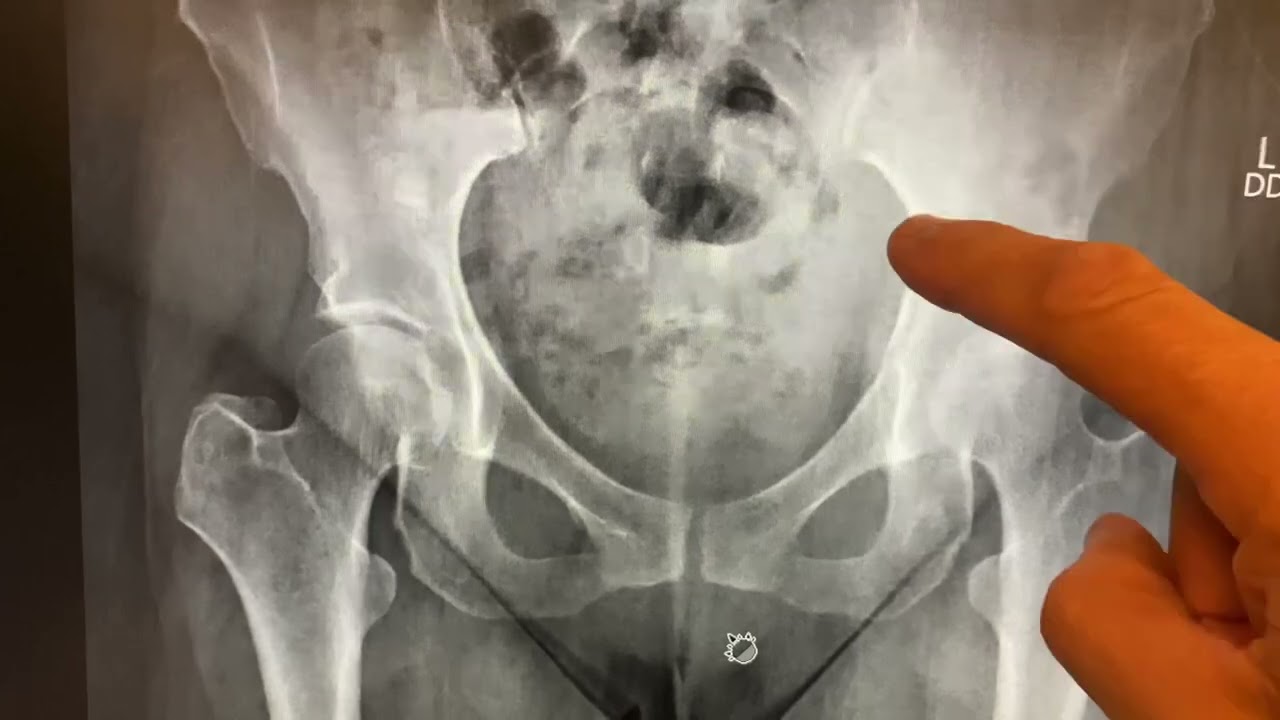 What Radioisotope Bone Cancer Looks Like On X Ray Extraosseous