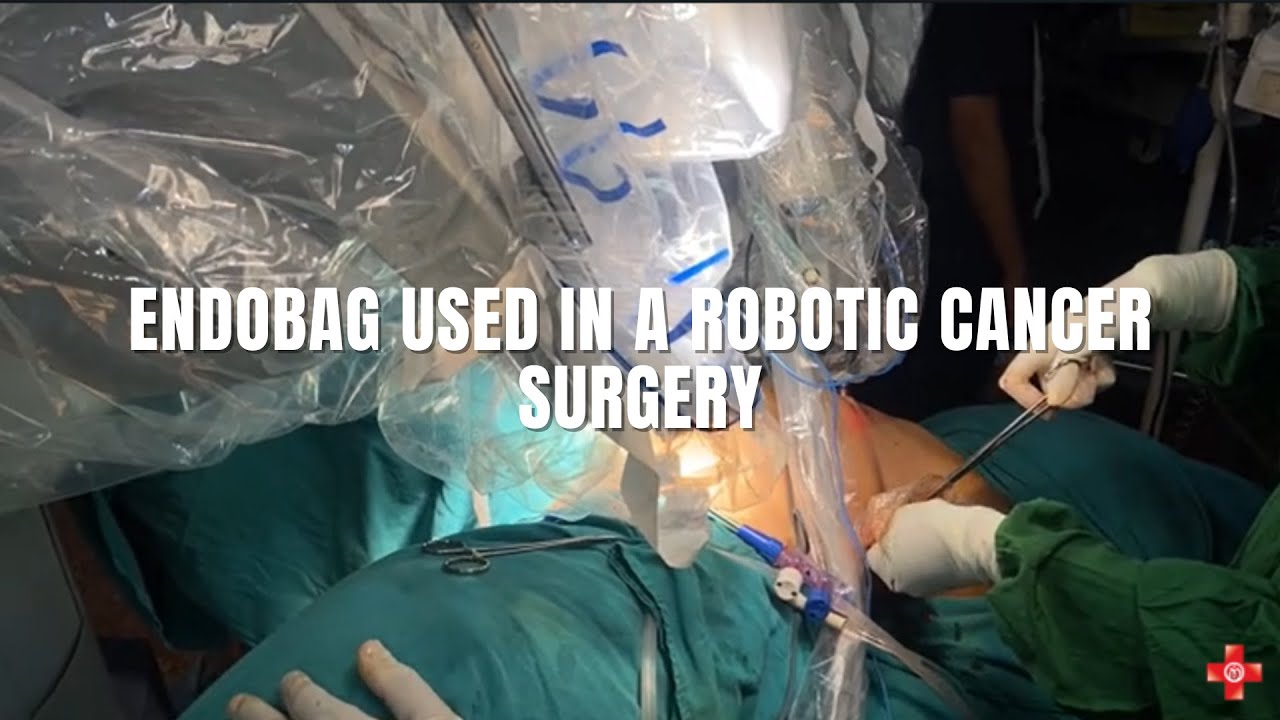 Morrisons Endobag used in a Robotic cancer surgery - YouTube