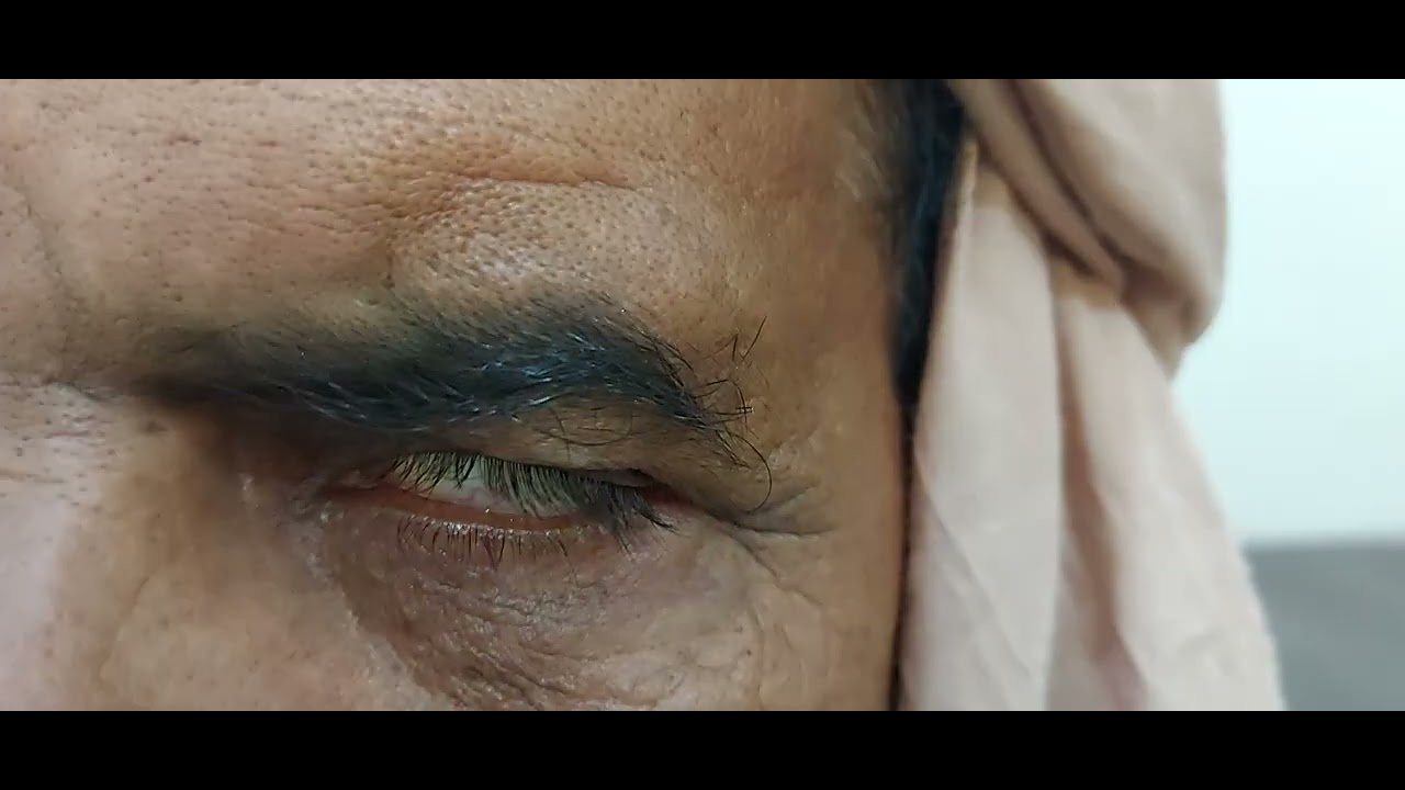 What is Bell's Phenomenon? - YouTube