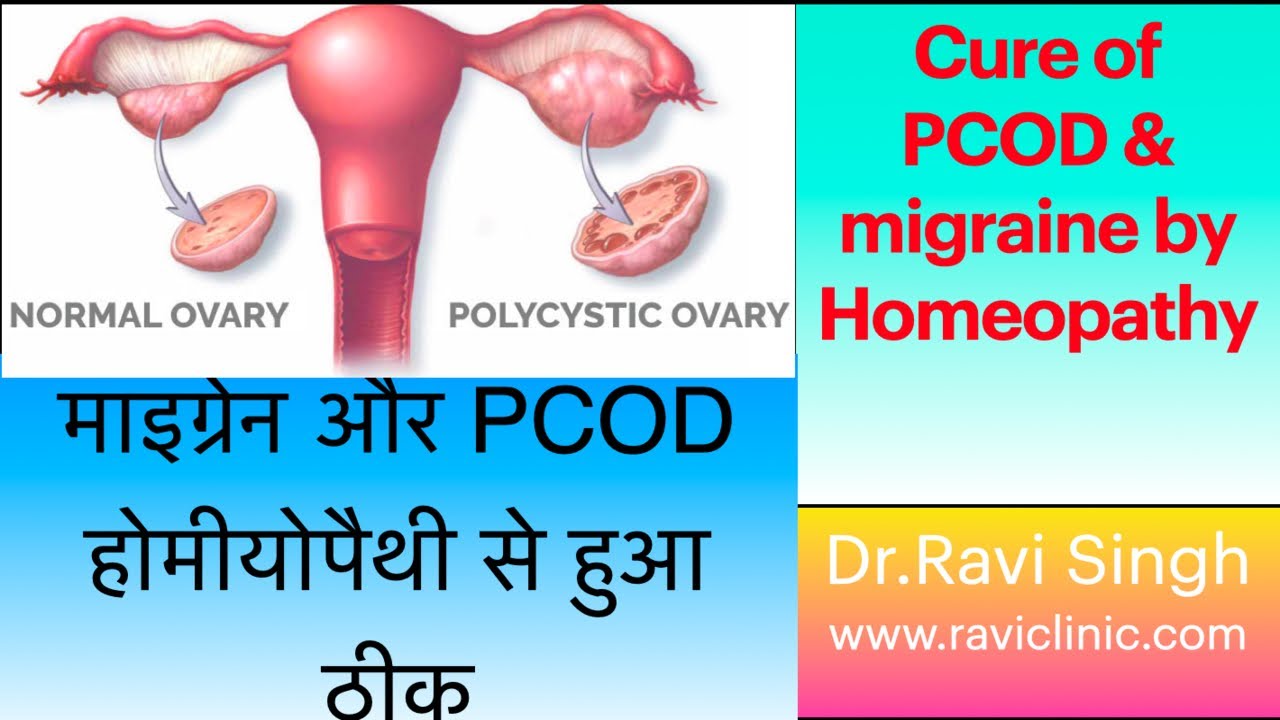 PCOD and Migraine Cured By Homeopathy - YouTube