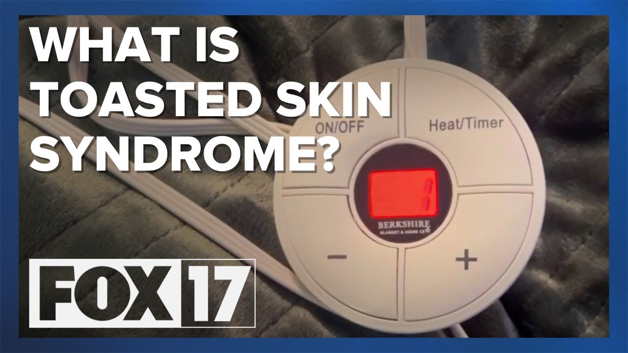 What is toasted skin syndrome? - YouTube