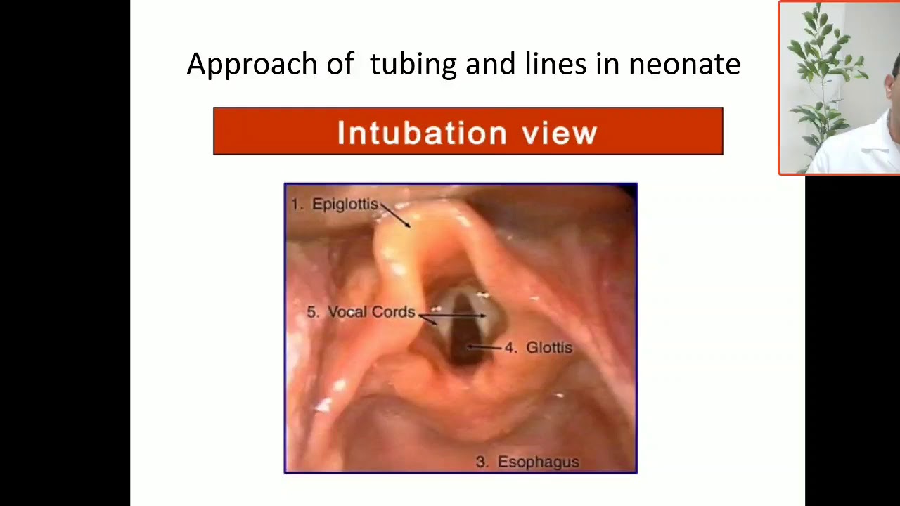 Case 22 approach for tubing and lines in neonates, ETT position - YouTube