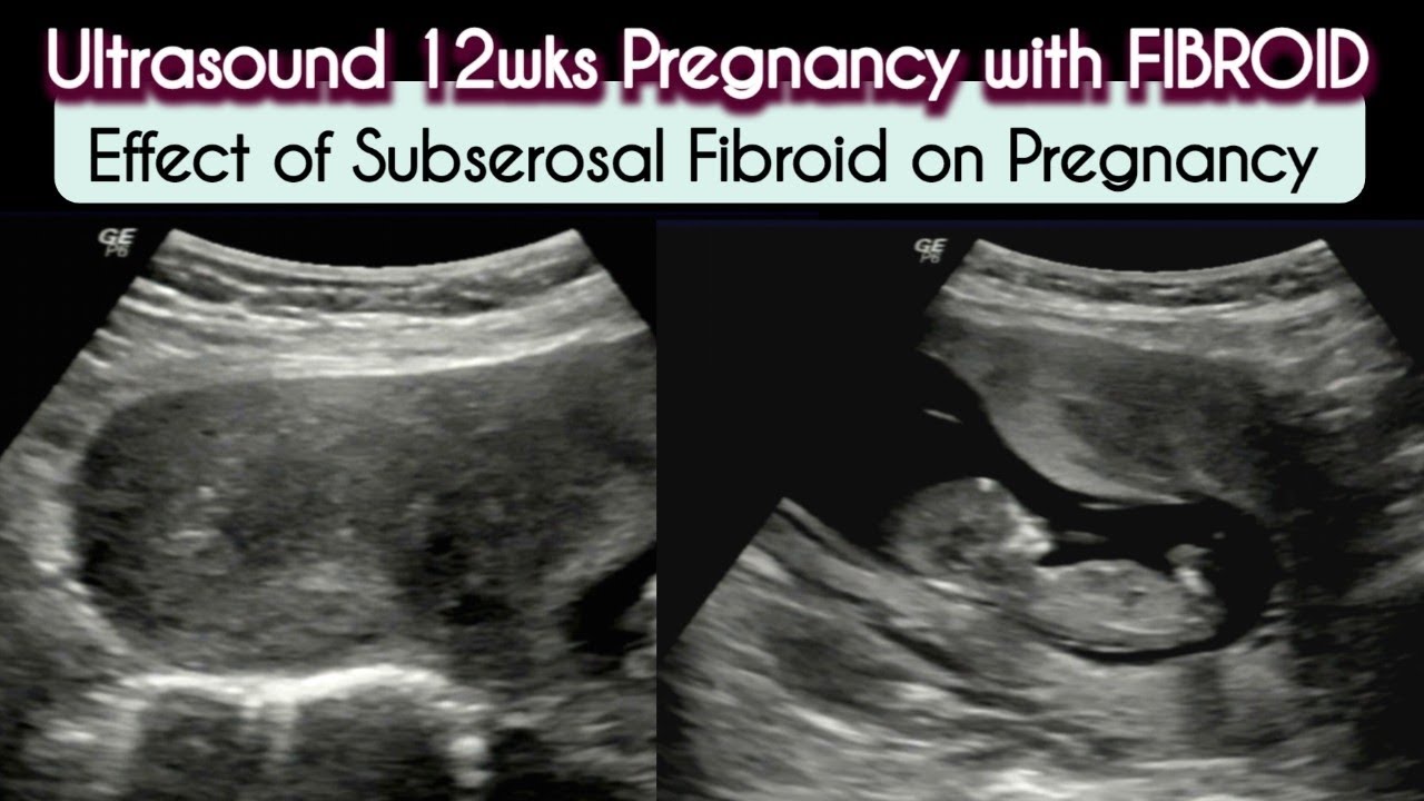 12wks Pregnancy Ultrasound - Effect of Large Subserosal Fibroid on ...