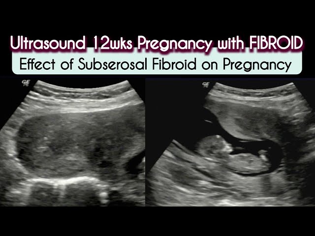 Ultrasound Cervical Fibroid With Pregnancy Preterm Birth And Uterine