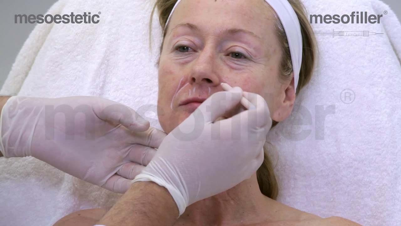 Mesofiller - perioral & nasolabial fold rejuvenation - YouTube