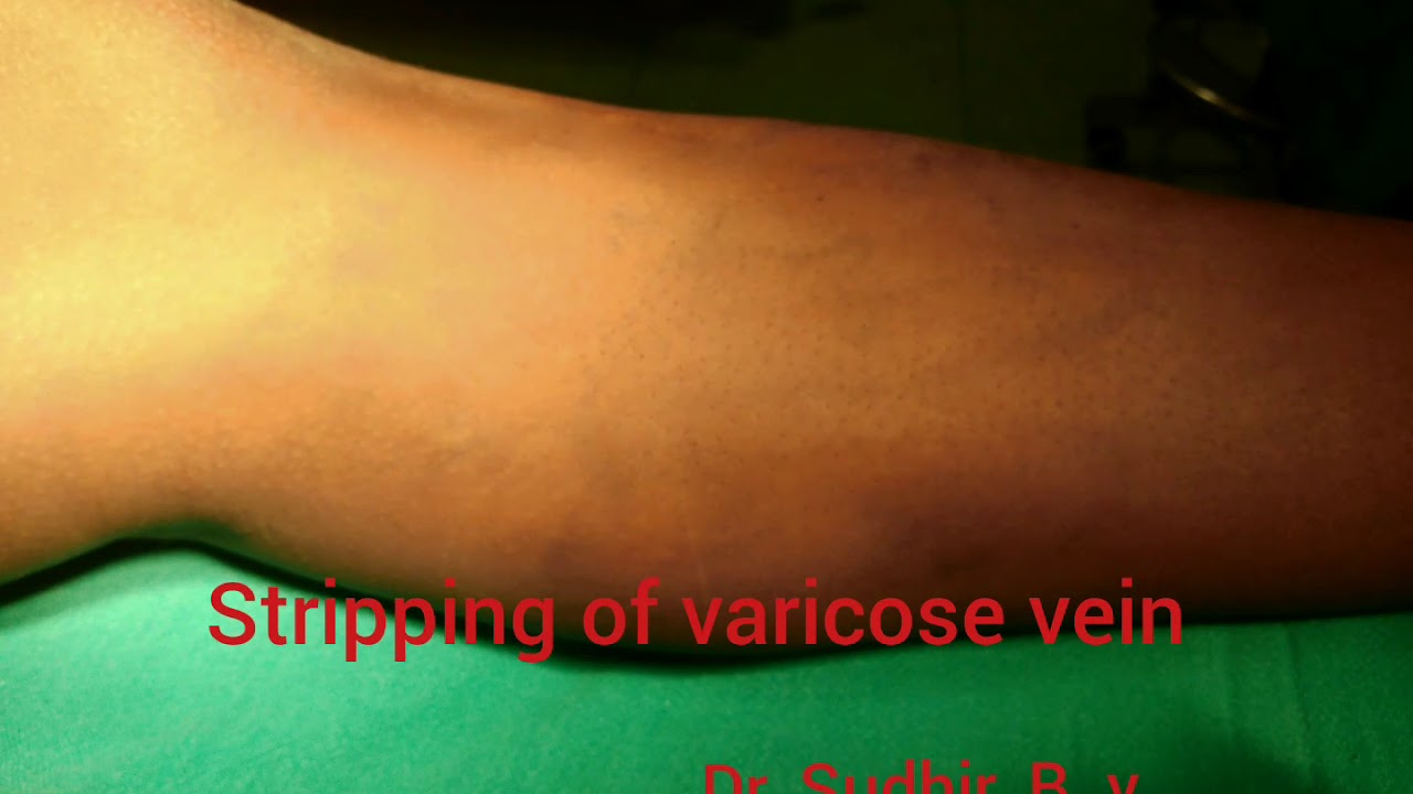 Stripping Varicose vein Long Saphenous Vein - YouTube