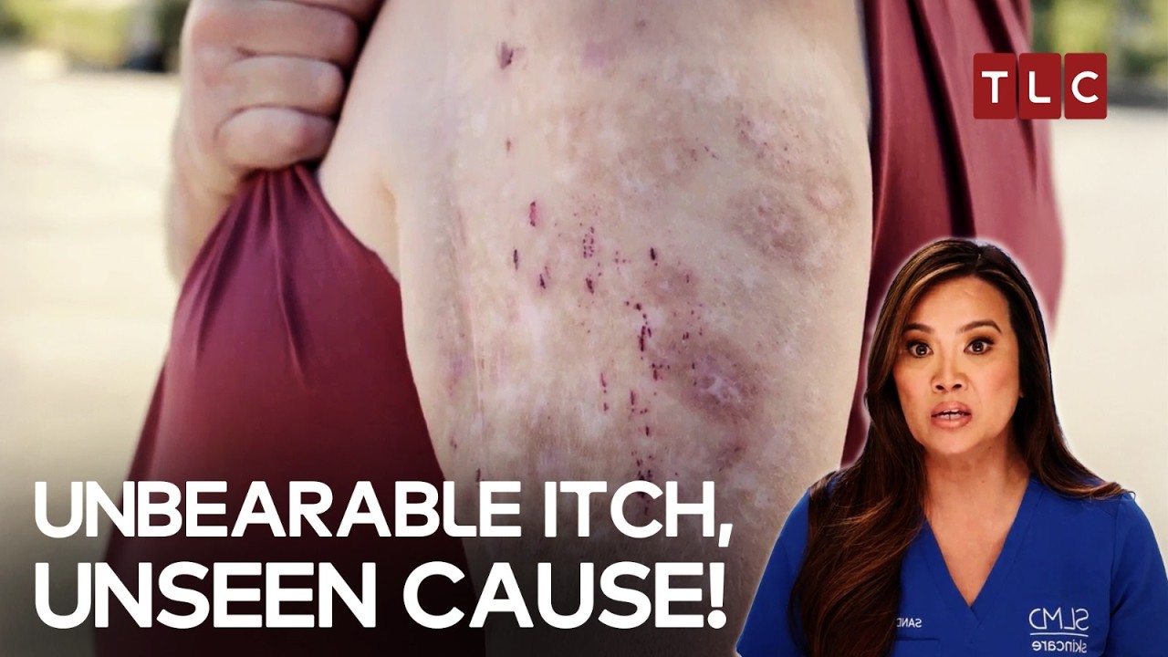 Man's Life Devastated by Unexplained Skin Condition | Dr. Pimple Popper ...