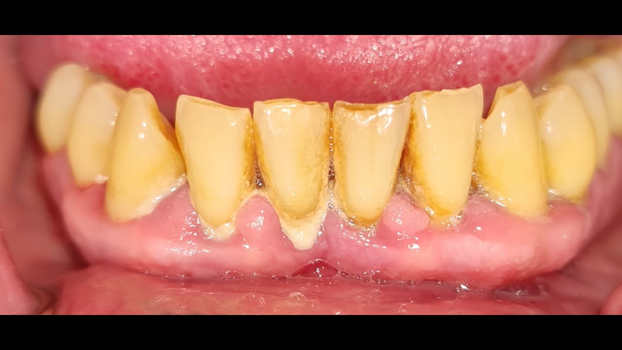 Deep scaling With GROSS Tartar Build Up At The Dentist - YouTube