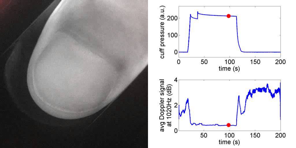 Occlusion-reperfusion of the thumb observed by laser Doppler holography ...