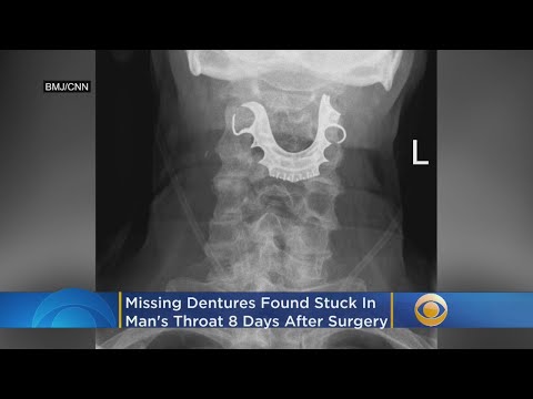 Missing Dentures Found Stuck In Man’s Throat 8 Days After Routine Surgery
