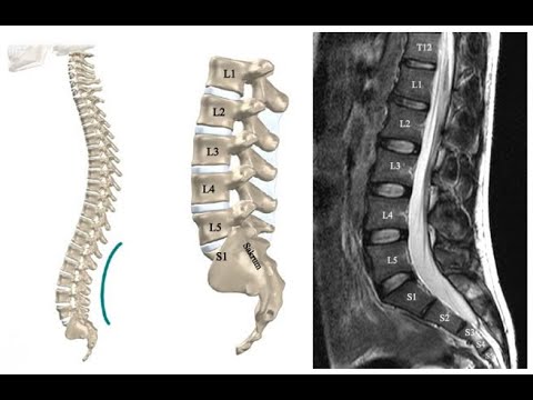 ✅L4-L5' de Bel Fıtığının %4'ü Görülür ❎Bel-Kalça ve Bacağa Vuran Ağrı Şikayeti İşaretli Alanda Olur❗