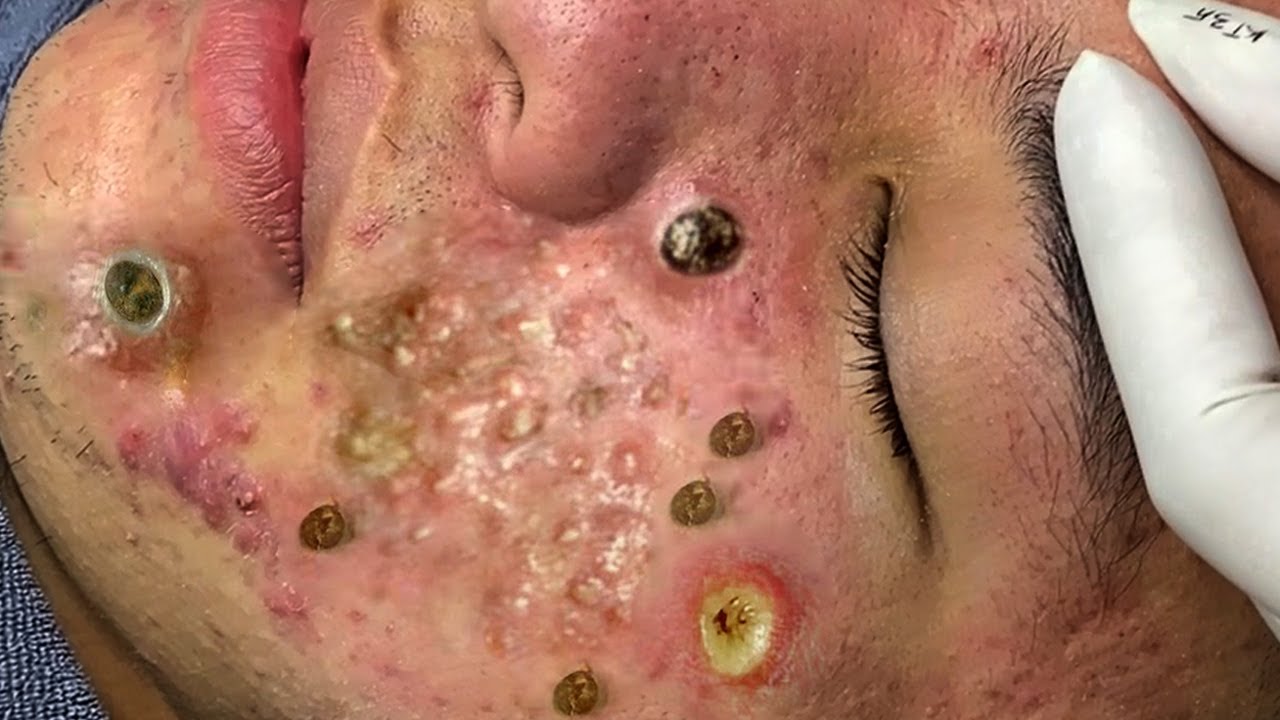 𝐌𝐨𝐬𝐭 𝐒𝐚𝐭𝐢𝐬𝐟𝐲𝐢𝐧𝐠 𝐏𝐢𝐦𝐩𝐥𝐞𝐬 𝐑𝐞𝐦𝐨𝐯𝐚𝐥 𝐀𝐭 𝐇𝐨𝐦𝐞 #1530 - YouTube