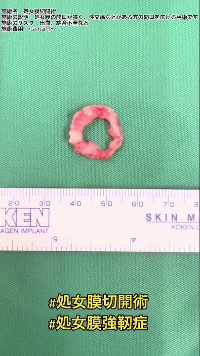 処女膜強靭症に対する処女膜切開術について Youtube