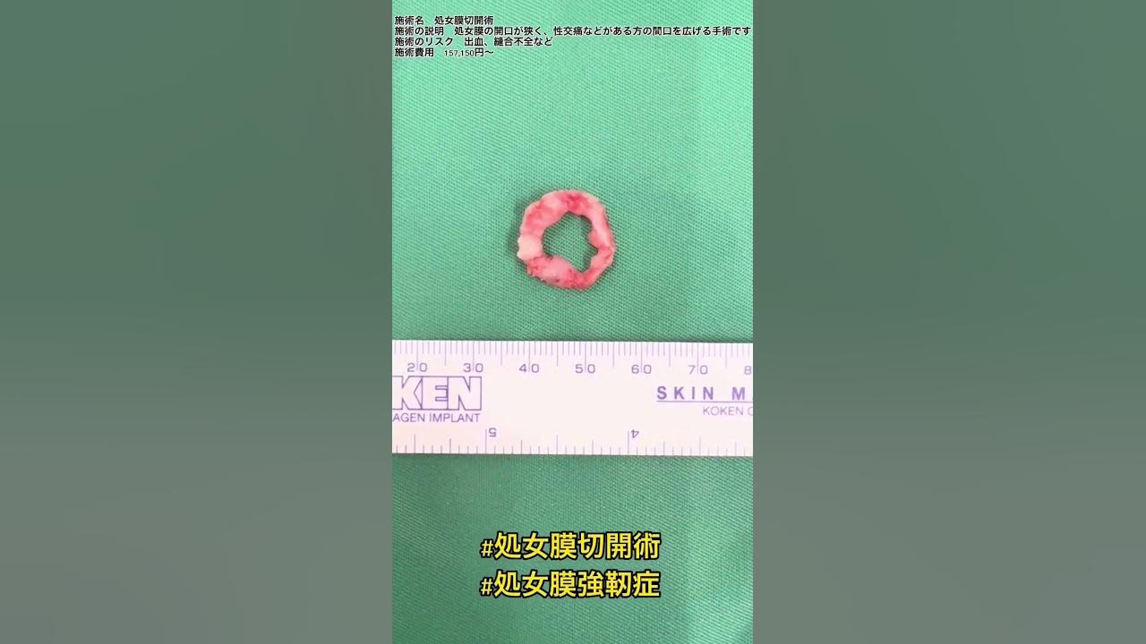 処女膜強靭症に対する処女膜切開術について Youtube