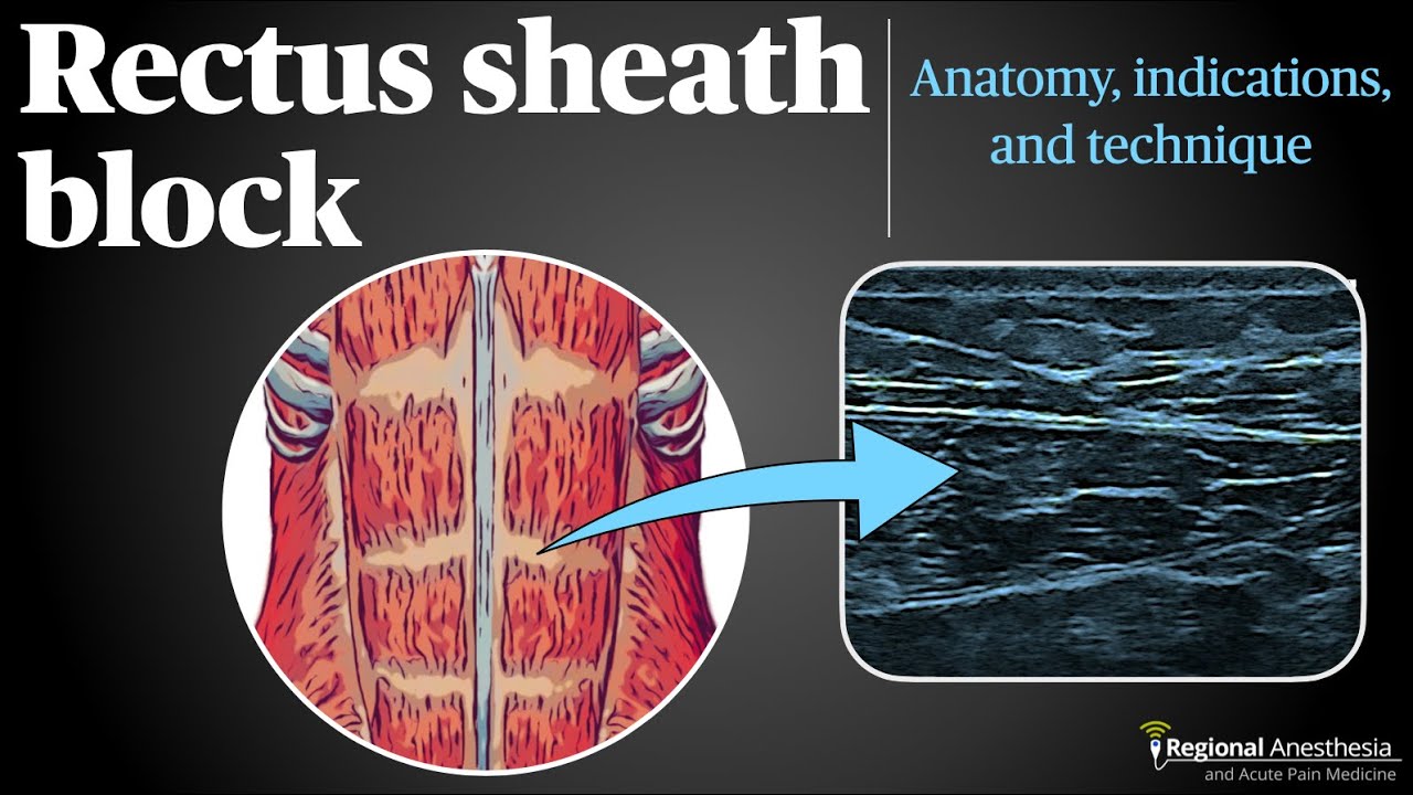 Rectus Sheath I Anatomy Lecturio Youtube