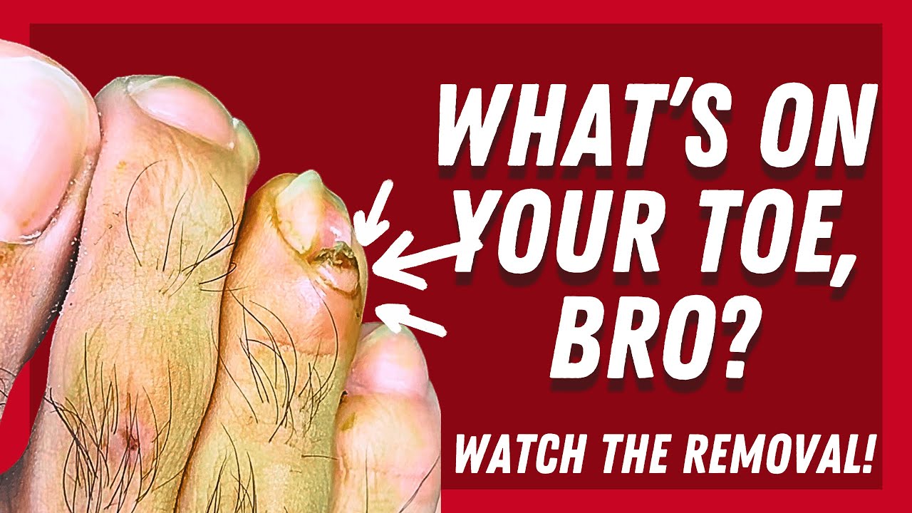 WHAT'S ON YOUR TOE, BRO? AMAZING GANGLION CYST REMOVAL! ASMR! - YouTube