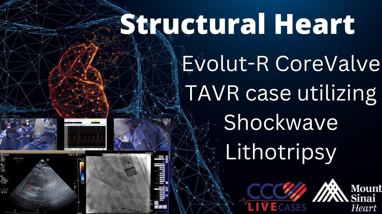 Evolut-R CoreValve TAVR case utilizing Shockwave Lithotripsy ...