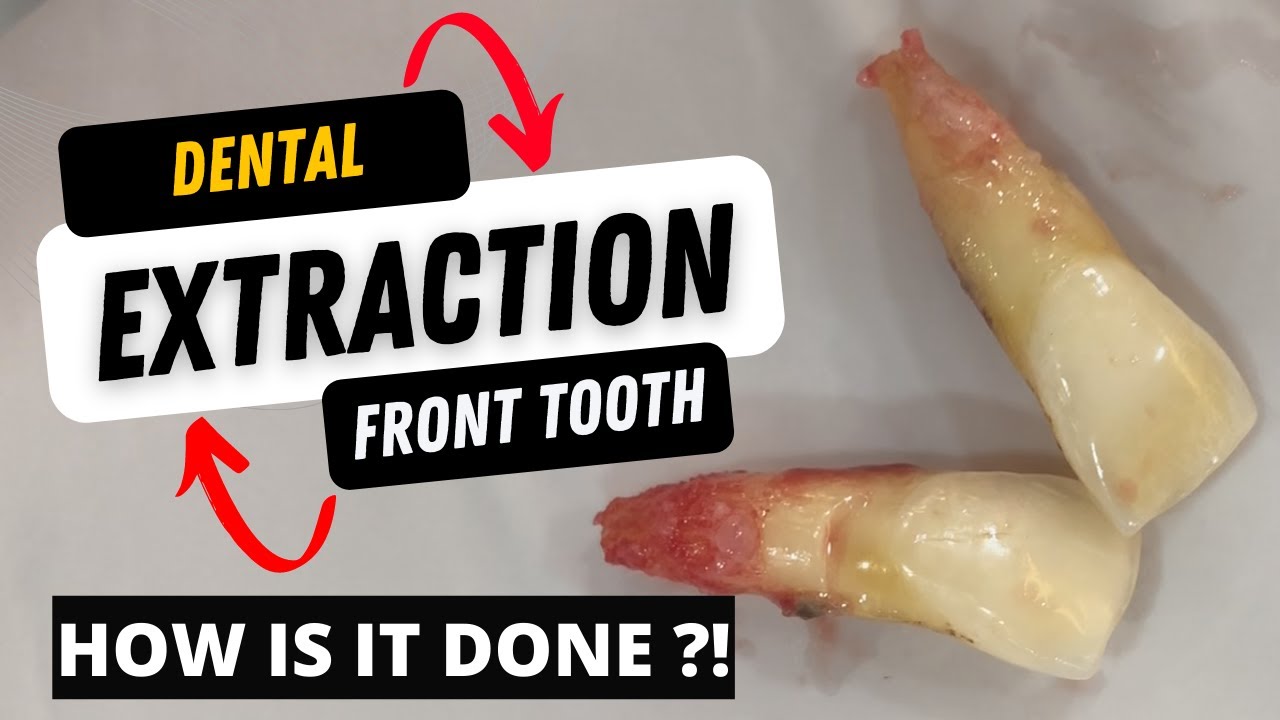 Simple Front Tooth Extraction - How is it done? #Teeth pulled by ...