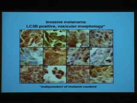 Autophagy: A Common and Targetable Feature of Malignancy