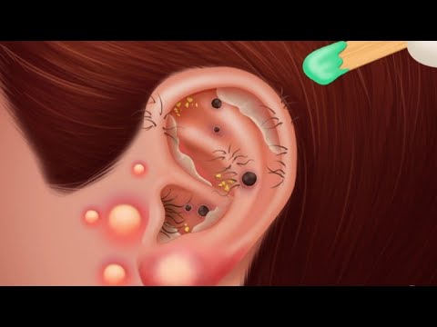 ASMR Ear wax removal & Ear cleaning animation - YouTube
