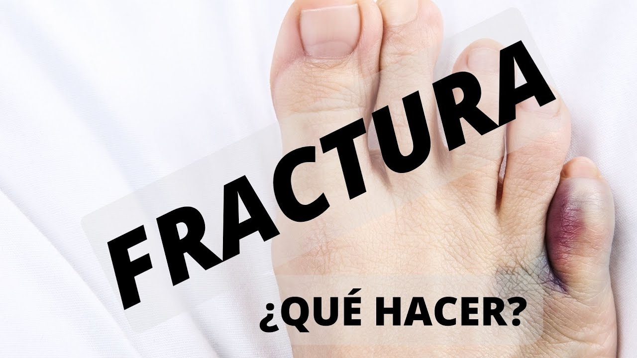 CÓMO INMOVILIZAR UNA FRACTURA DE UN DEDO DEL PIE - YouTube