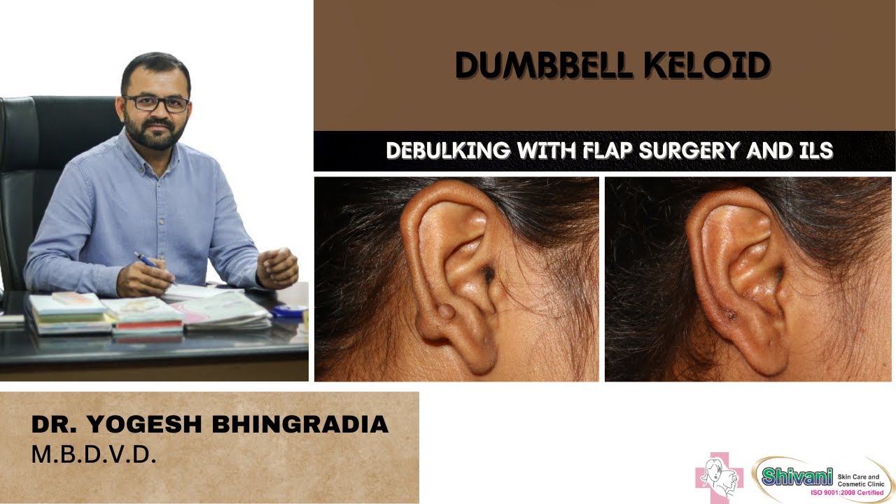 DUMBBELL KELOID | EARLOBE KELOID REMOVAL | FILLET FLAP SURGERY | DR ...