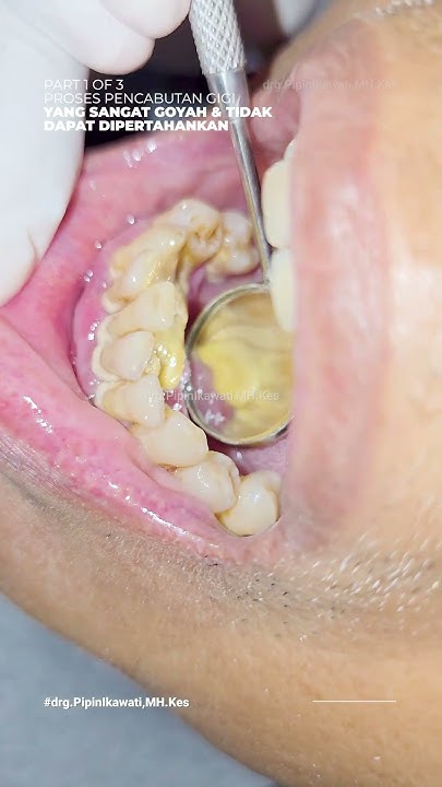 PROSES PENCABUTAN GIGI YANG SUDAH GOYAH DAN TIDAK DAPAT DIPERTAHANKAN || PART 1 OF 3 - YouTube