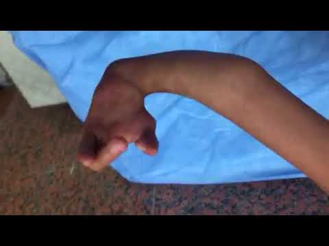 radial club hand - YouTube