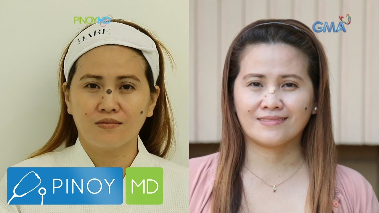 Pinoy MD: Peligro ng 'buhay' na nunal, alamin - YouTube