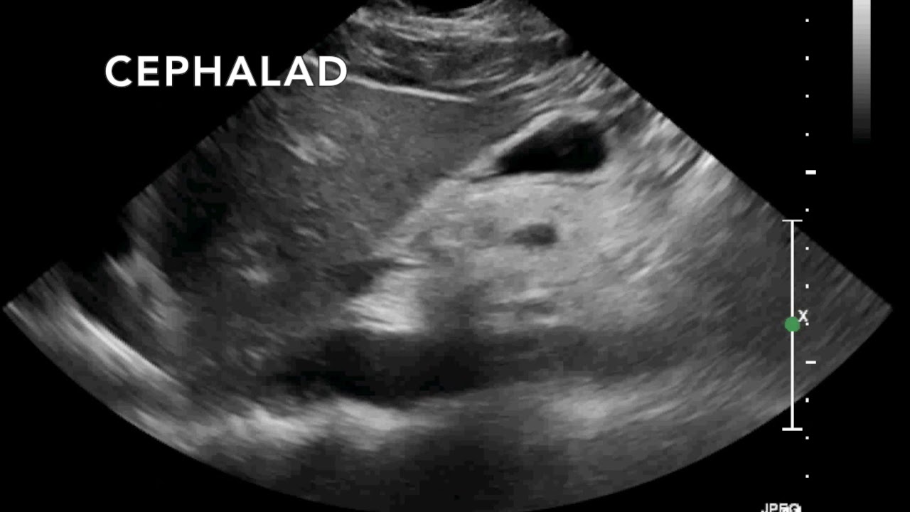 Gastric Ultrasound - YouTube