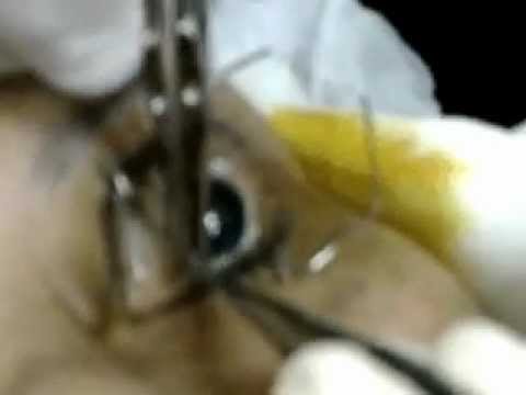 Subtenon eye block in cardiac patient - YouTube
