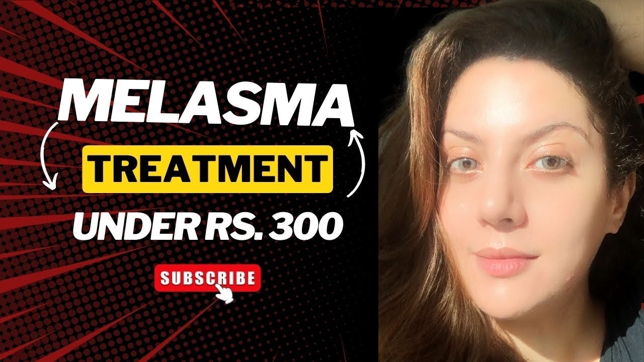 Melasma Removal at Home I Melasma Remove cream under Rs 300 I Melasma ...