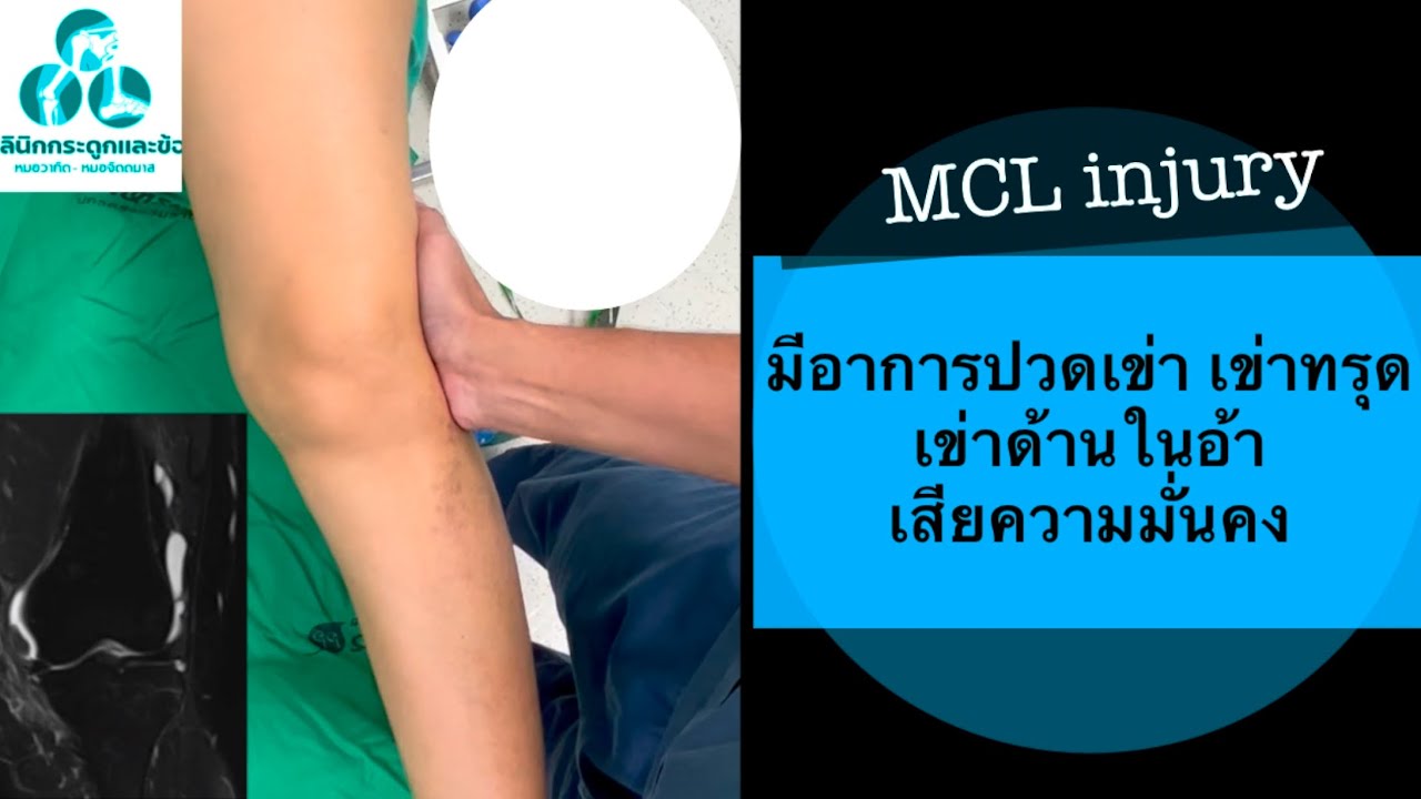 เอ็นเข่าด้านในบาดเจ็บ (MCL injury) MCL reconstruction - YouTube
