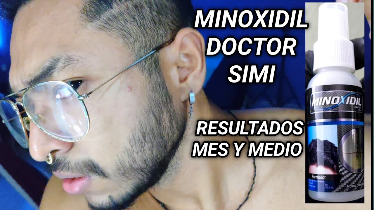 Minoxidil Mes y medio | Usando Minoxidil Doctor Simi resultado | Cómo ...