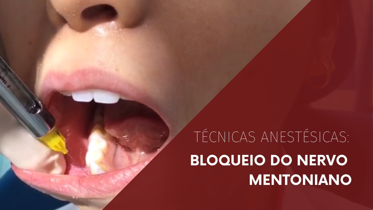 Anestesia Do Nervo Mentoniano - RETOEDU