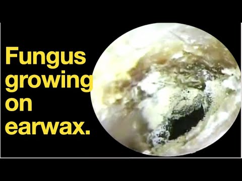 Fungus growing on earwax. |ear wax removal | ear cleaning | ASMR ...