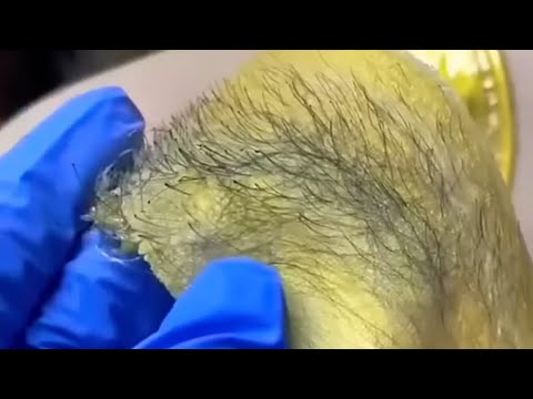 Brazilian hairy legs sugarwaxing for beginners(16)#brazilian#waxing#viral#wax#sugaring#sugarwax