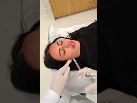 CANELA SKIN FACIAL PROCEDURE 💉 @doctorcastellar2252