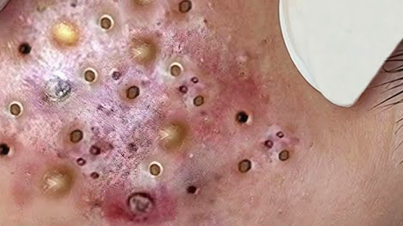 Most Satisfying Video Face Skin Care with Calm Music | Acne Treatment ...