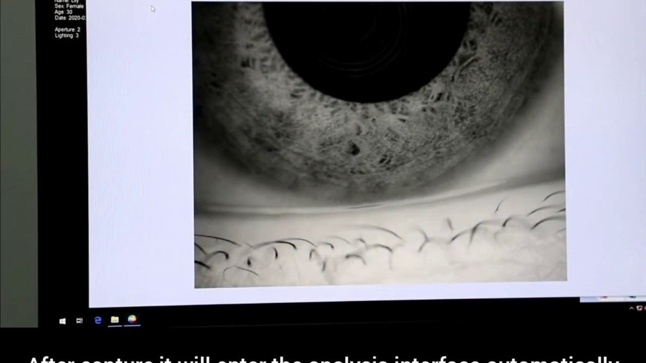 1.Tear Meniscus Height by Kanghua Dry Eye Analyzer Operation Guide ...