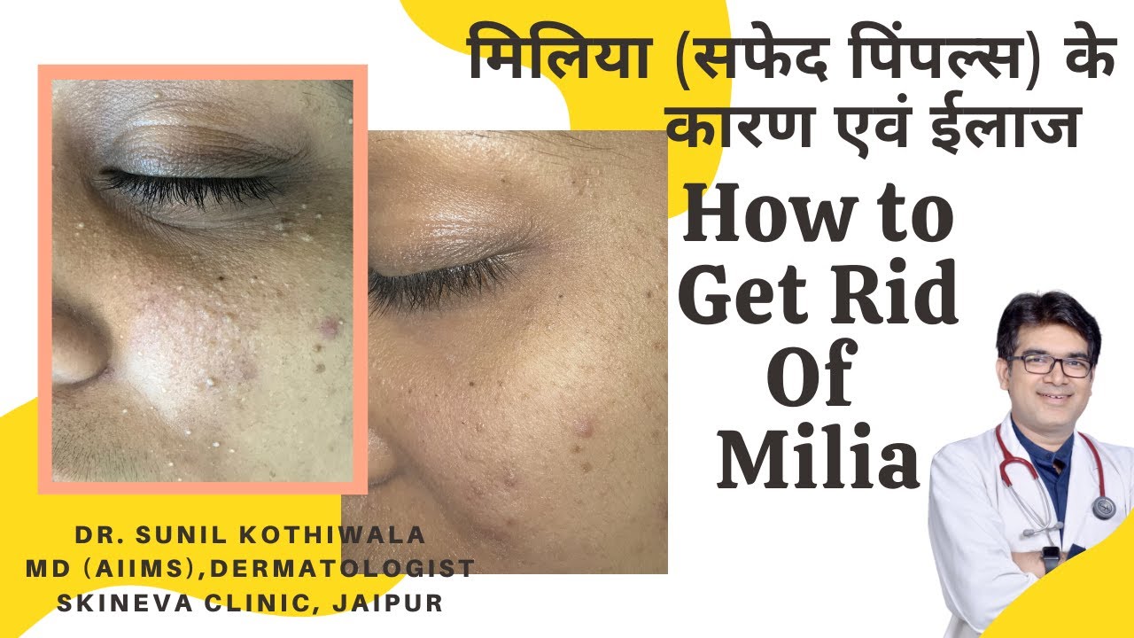 Milia को कैसे ठीक करे | Milia Removal Treatment in Hindi | Milia ...