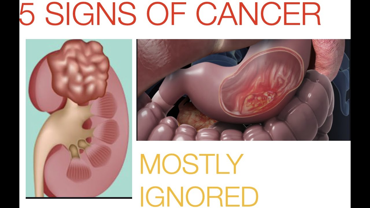 WHAT ARE THE 5 SIGNS OF CANCER ?? - YouTube