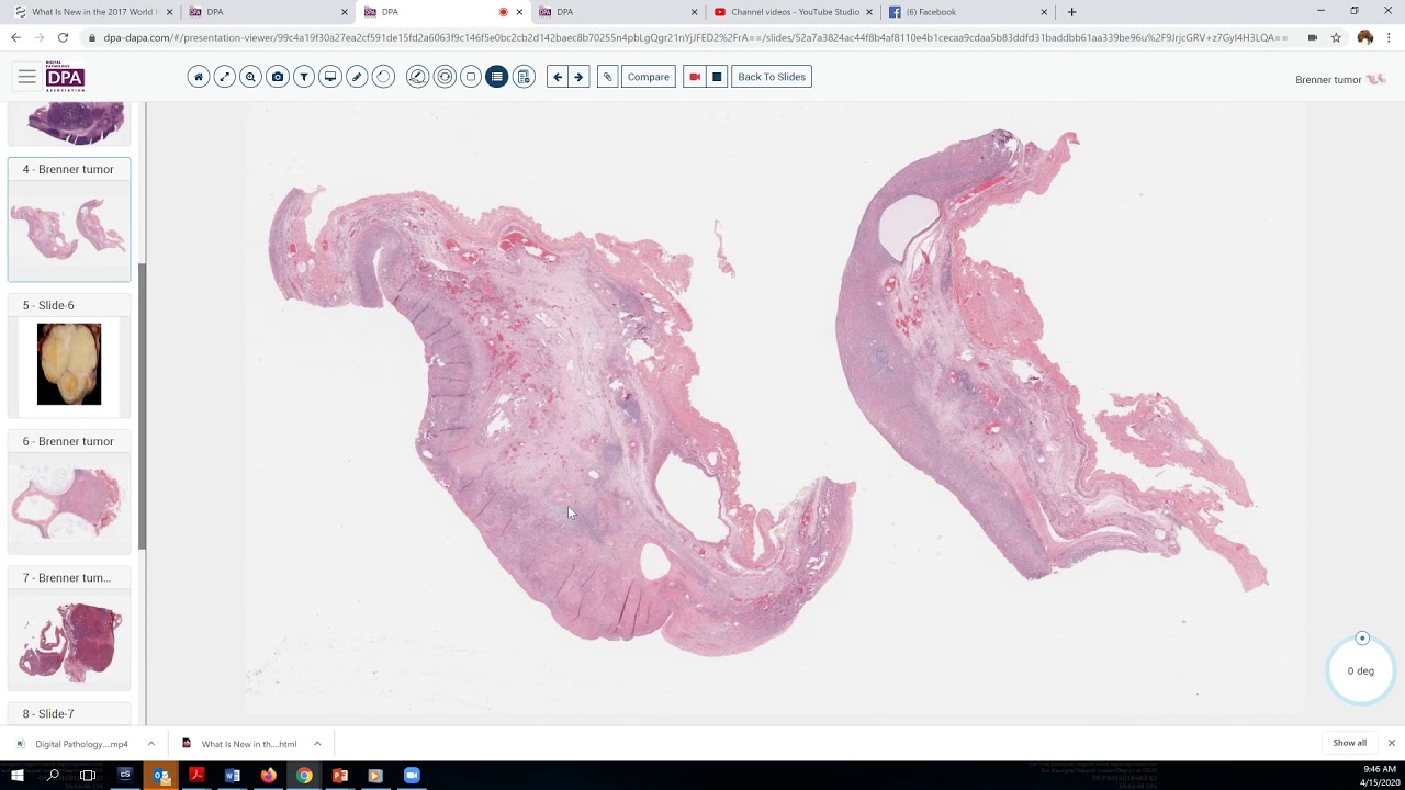Digital Pathology Sign out 22- Brenner tumor - YouTube