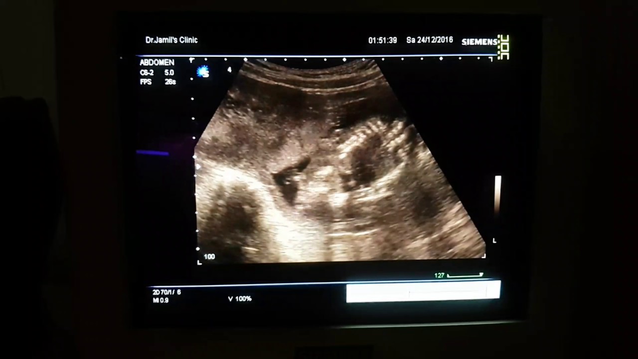 Acrania Ultrasound - YouTube