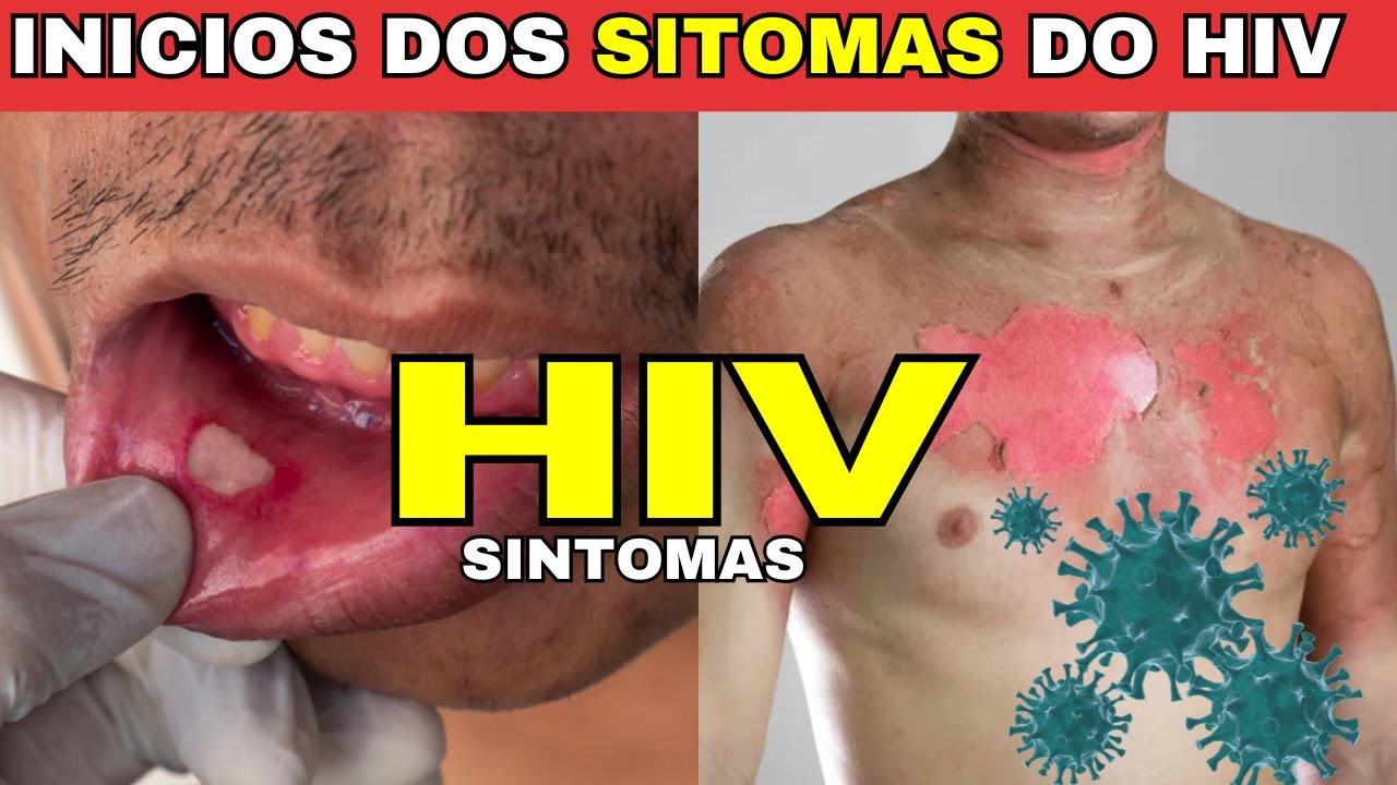 10 SINAIS DE HIV NO HOMEM QUE VOCÊ PRECISA SABER - YouTube
