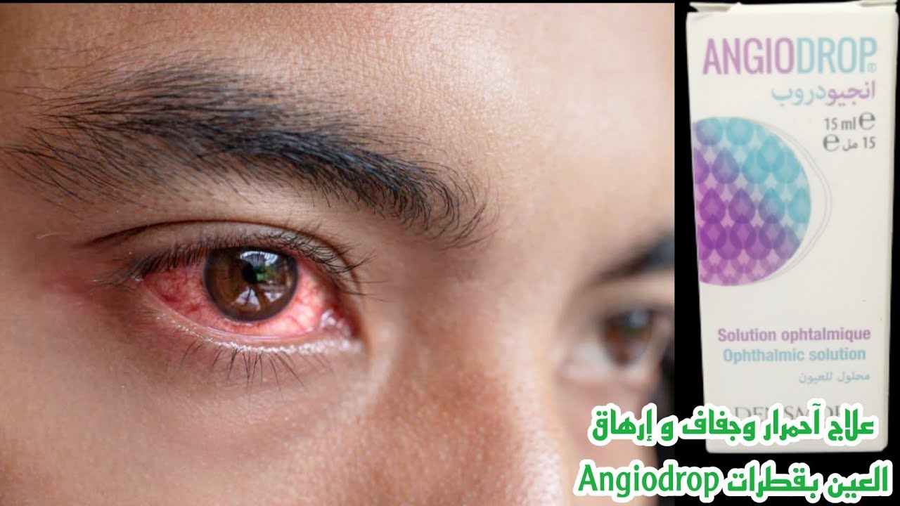 علاج آحمرار وجفاف و إرهاق العين بقطرات Angiodrop - YouTube