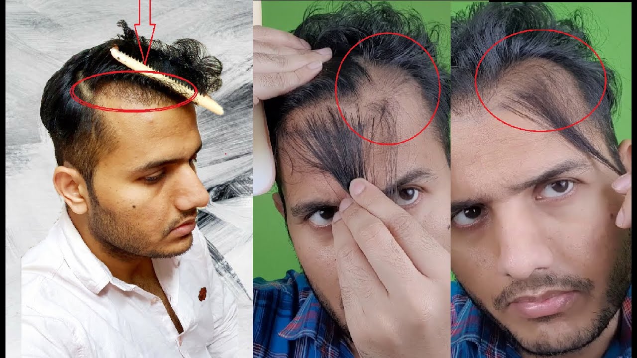 Hair Transplant Failure - Aur Hair Transplant Failure se Kaise bache ...
