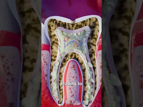 How A Tooth Abscess Develops 😬