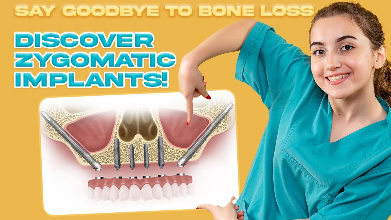 😁👌 "Say Goodbye to Bone Loss: Discover Zygomatic Implants!" 🦴 - YouTube