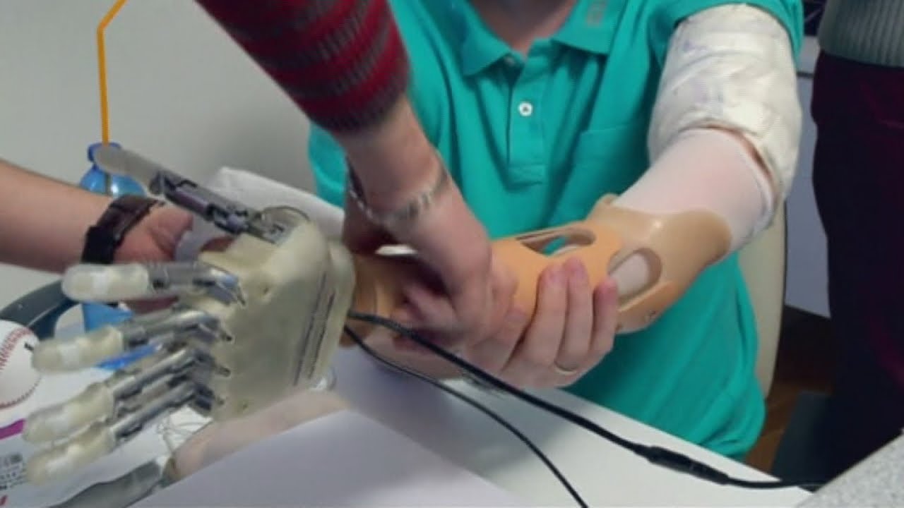 First bionic hand with real feeling - YouTube